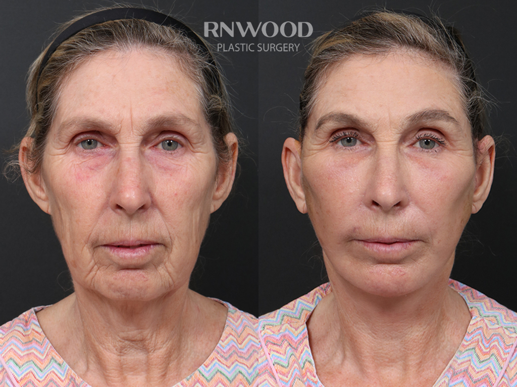 Liz F/63 Australia - RNWOOD Seoul